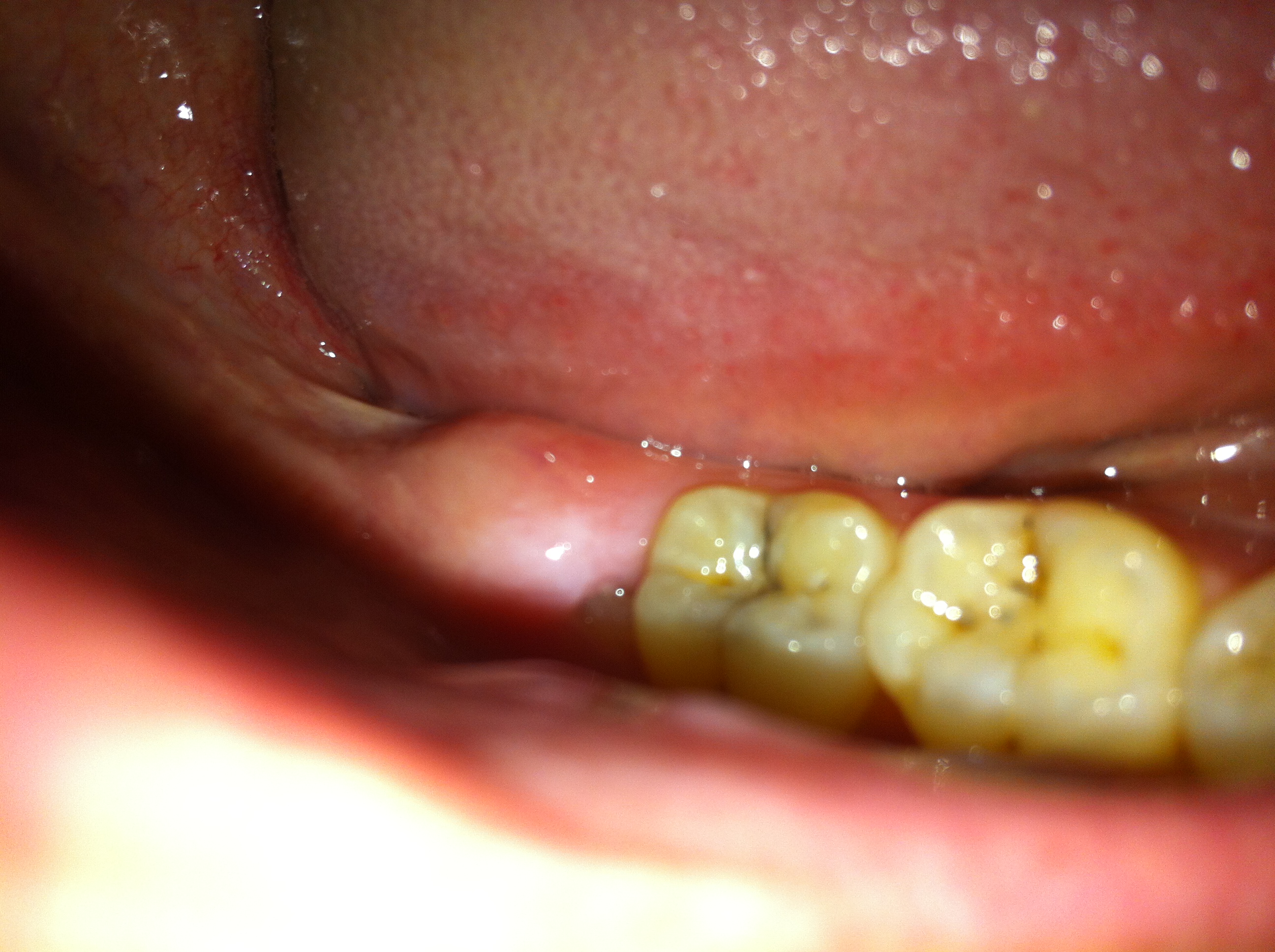 verstandskies komt door en ruimtegebrek | Tandarts.nl Forum